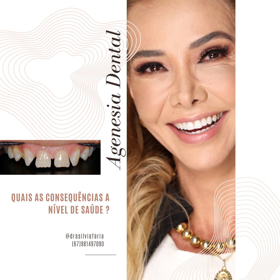 Agenesia dental, quais as consequência a nível de saúde? - SouRiso ...