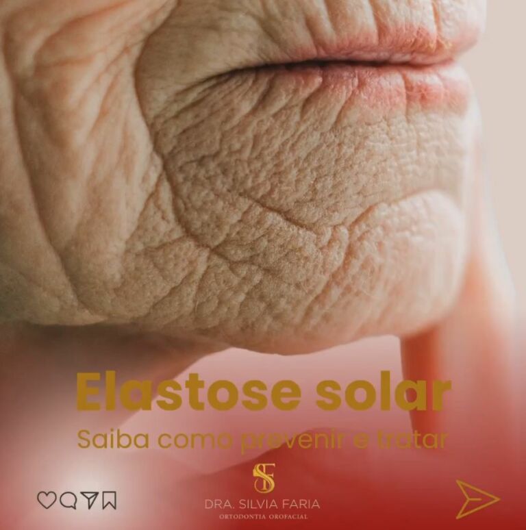 Elastose solar, saiba como prevenir e tratar - SouRiso - Dra. Silvia ...
